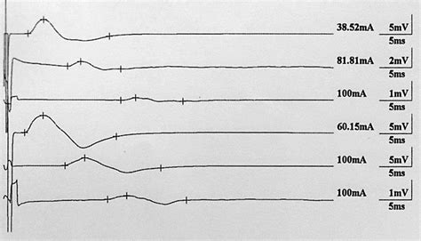 Conduction Block In Median Nerves Right Limb In The Upper Half And