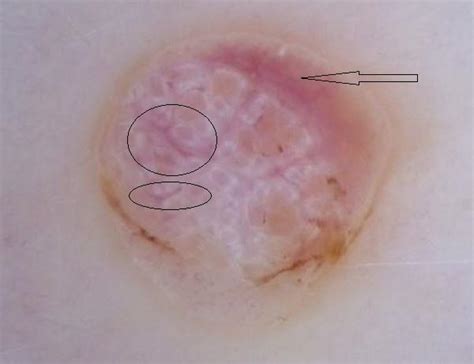 Vessel Patterns In Dermoscopy
