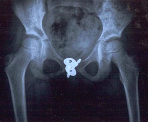 An Unexpected Cause Of Vaginal Bleeding The Role Of Pelvic Radiography