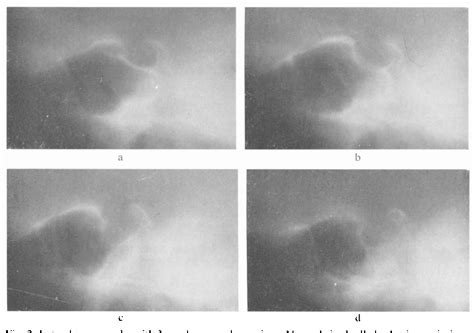 Figure 2 From Prolactin Secreting Pituitary Microadenomas Semantic