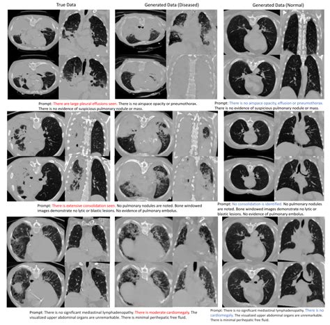 医学生成模型medsyn：文字引导，ai“画”出高保真ct图像 Csdn博客