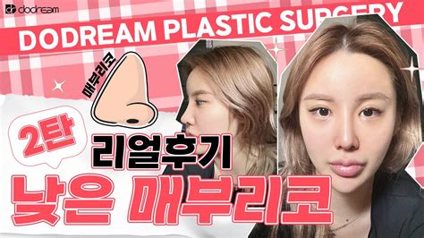 두드림tv 코 성형 한 달 차 모든 과정 코성형 브이로그 2탄💕 코성형 Vlog Youtube