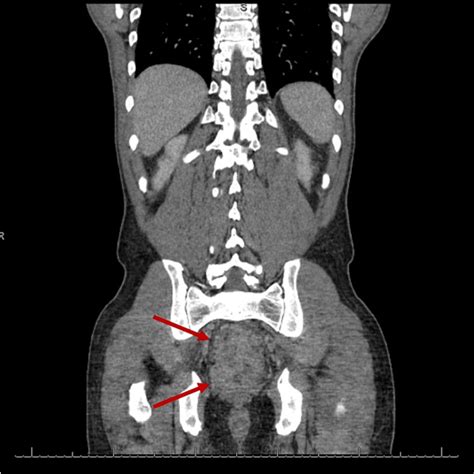 Initial Ct With Coronal Images Demonstrating A Rectal Mass Concerning