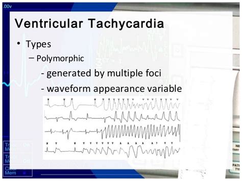 Lethal Cardiac Rhythms Manual Defibrillation