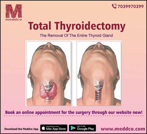 Thyroid Nodules Removal