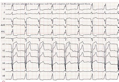 Topic Complete Left Bundle Branch Block 12 Lead Ecg Certification Course Acls