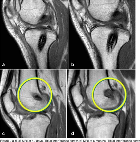 Figure 1 From Correlation Between Fixation Systems Elasticity And Bone