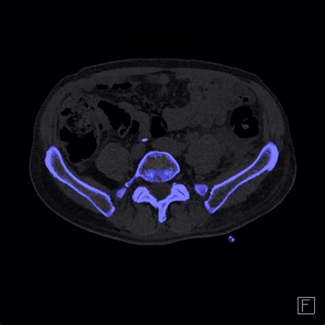 Percutaneous Nephrolithotomy
