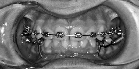 Application Of The Skeletal Anchoraged Forsus Fatigue Resistant Device Download Scientific