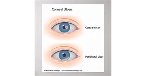 Corneal Ulcer Drawing Poster Zazzle