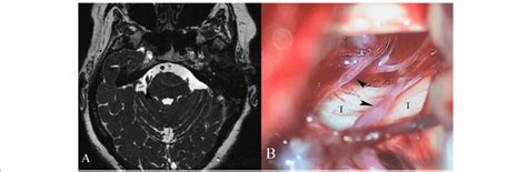 A Fiesta Showing Vascular Compression At The Root Of The Right
