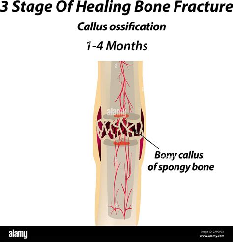 3 Stage Of Healing Bone Fracture Callus Ossification The Bone