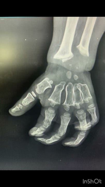 Dysostosis Multiplex Mucopolysaccharidosis Radiologyshorts Radiography Youtube