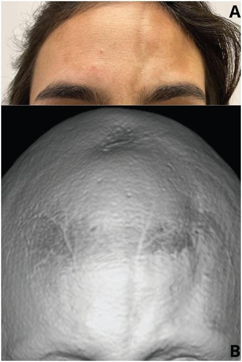 Multiple Cerebral Cavernomas In Linear Scleroderma An Unusual Association Arquivos De Neuro