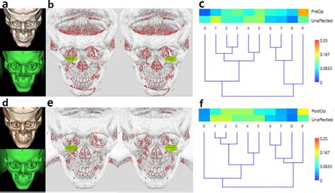 Similarity Analysis Of The Inferior Orbital Rim Using Bcsi And