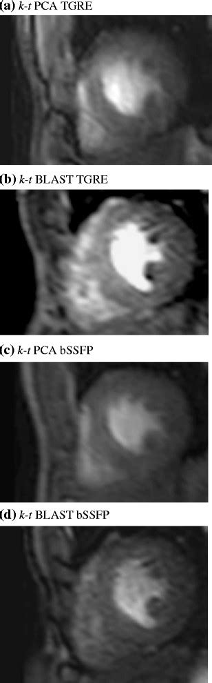 single slice volunteer example of 3d spoiled gradient echo tgre and