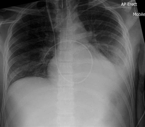 Swan Ganz Catheter Radiology Case 44 Off