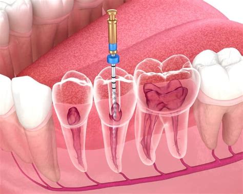 Root Canal Pain Dealing With Pain After Root Canal