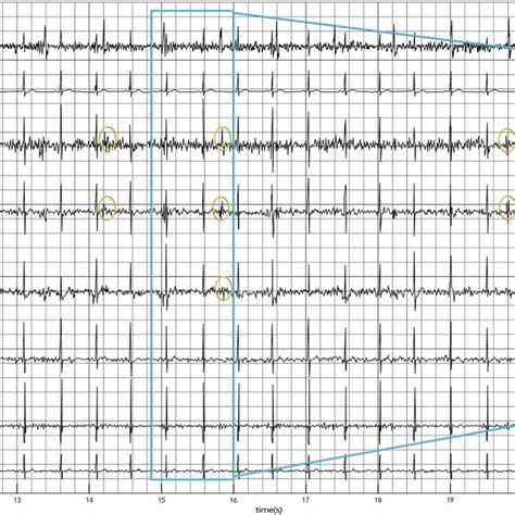 Comparison Of Extracted Fetal Electrocardiogram Signals In Methods