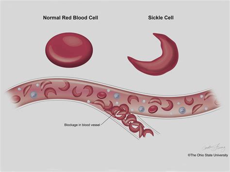Sickle Cell Coloring Pages 2025