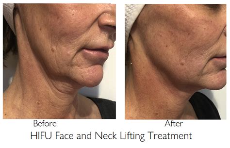 Hifu Superior Skin Firming And Lifting House Of Beauty