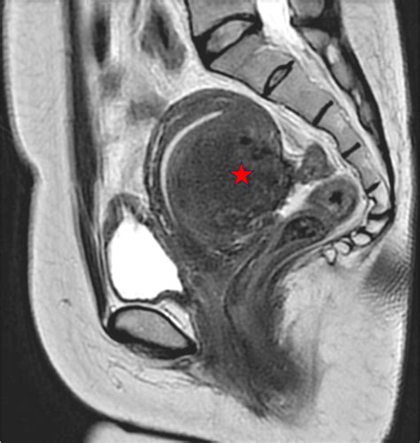 Diagnosis Of Adenomyosis Adenomyosis How To Diagnose