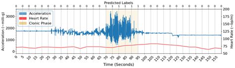 1d Convolutional Neural Network Detecting A Tonic Clonic Event A Download Scientific Diagram
