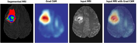 Heatmap Generated At A Particular Depth Of An MRI Download Scientific Diagram