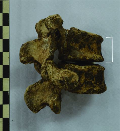 Compression Fracture Of The First Lumbar Vertebra Upper Body In The