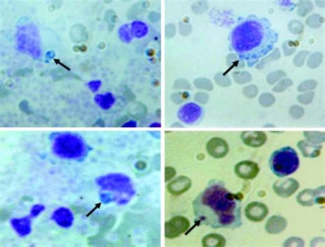 Human Monocytotropic Ehrlichiosis Wikiprojectmed