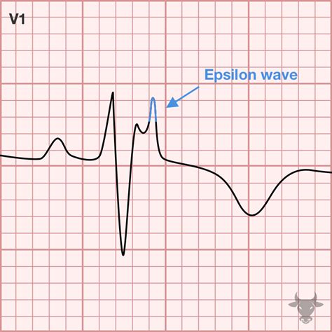 Glossary Ecg Stampede