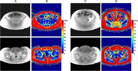 A Deep Learning Aided Bone Marrow Segmentation Of Quantitative Fat Mri For Myelofibrosis