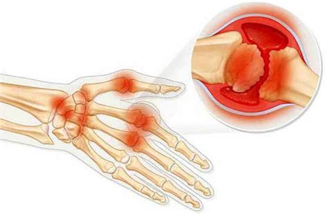 Rheumatoid Polyarthritis Medtour