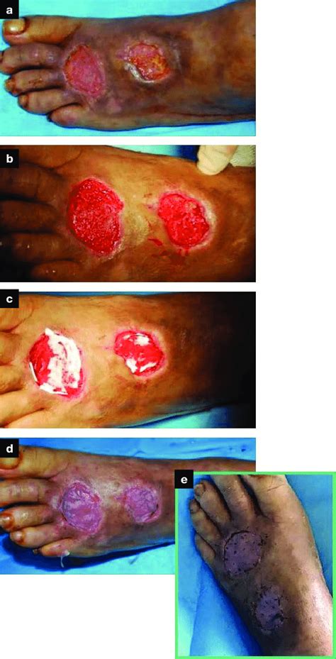 Vascular Chronic Ulcer Treated With Acellular Dermal Matrix And