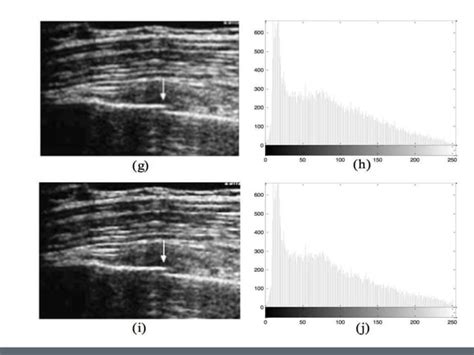 Enhancement Of Bone Fracture Image Using Filtering Techniques Ppt