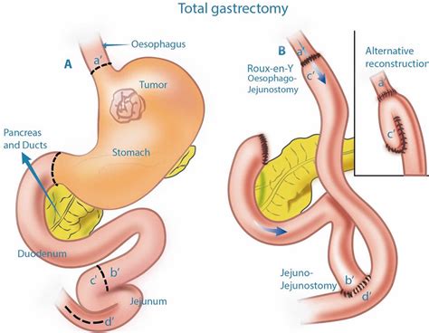 Partial Gastrectomy