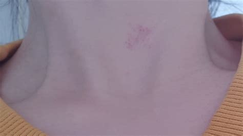 목에 붉은 점 흉터 지식in