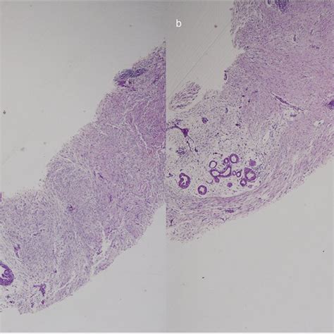Spindle Cell Proliferation Was Observed Between Ductal Structures Of