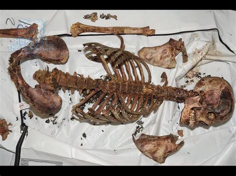 Skeletonization Of The Human Body Rnsfl