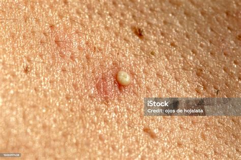 햇볕에 등 피부의 피부에 크고 못생긴 노란색 여드름을 매크로 클로즈업합니다 여드름 주위의 피지가 붉어지는 피지로 가득 찬 등 피부의 여드름 여드름 개념 건강관리와 의술에