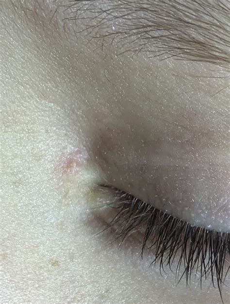 Is This Molloscum R Molluscum