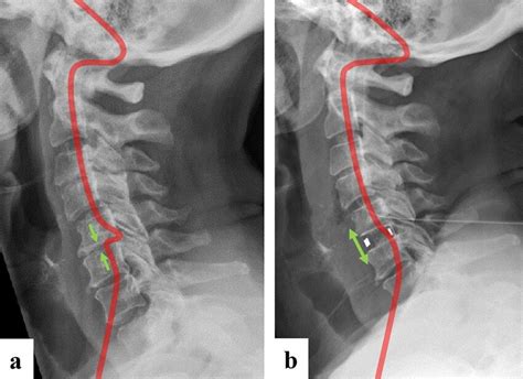 Concept Of Ardf A The Artery Loop Has Developed Due To Relative Download Scientific Diagram