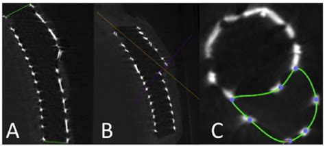 Assessment Of The Stent Opening Diameters And Areas Diameters Were Download Scientific Diagram