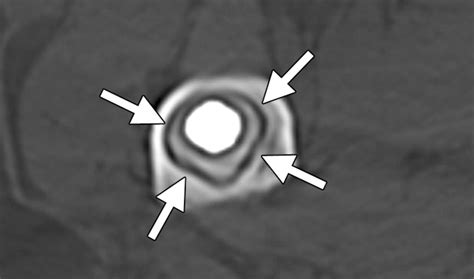 Virtual Monochromatic Spectral Imaging With Fast Kilovoltage Switching Reduction Of Metal