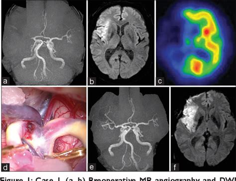 Figure 1 From Surgical Embolectomy For Middle Cerebral Artery Occlusion After Thrombolytic
