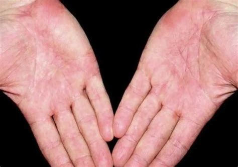 Eritema Multiforme Nedir Ankara Masası