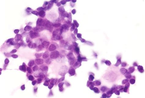 Granular Cell Tumor Cytology