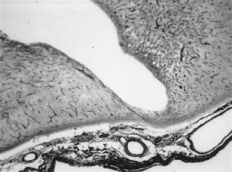 Multiple Subpial Transections And Other Interventions Neupsy Key