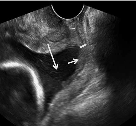 Longitudinal View Of A Short Cervix With Funneling The Line Indicates Download Scientific