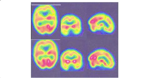 Pre Treatment Upper Rows And Post Treatment Lower Rows Spect Images Download Scientific